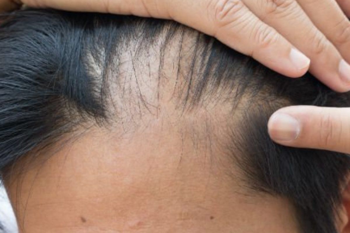 How Does Male Baldness Start? - HN Magazine