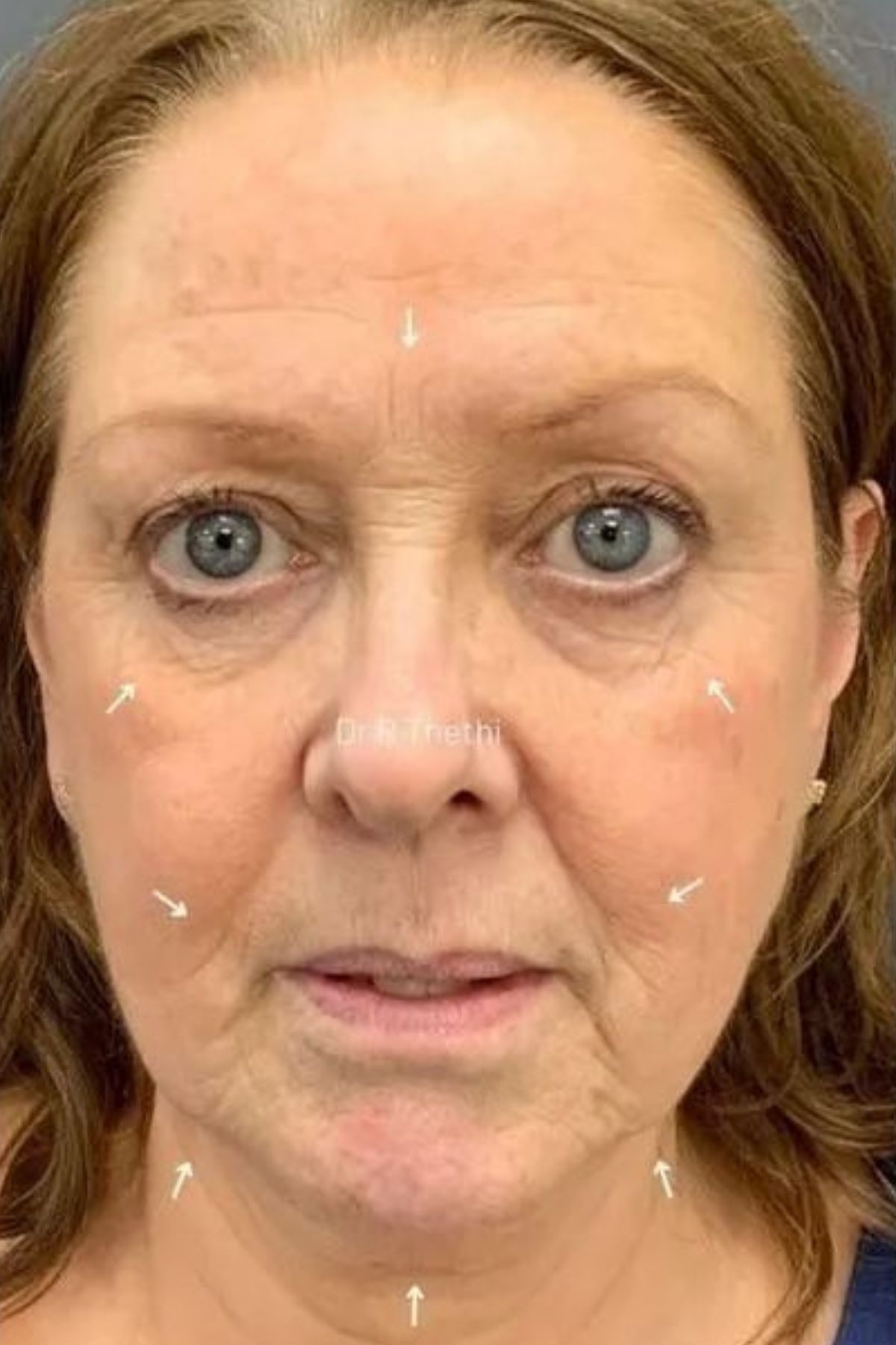 Everything You Want to Know About Fillers - HN Magazine
